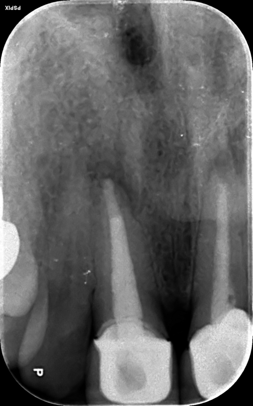 Case 19 - Endodontics - Graystone Referral Centre | Referrals in Hassocks, West Sussex