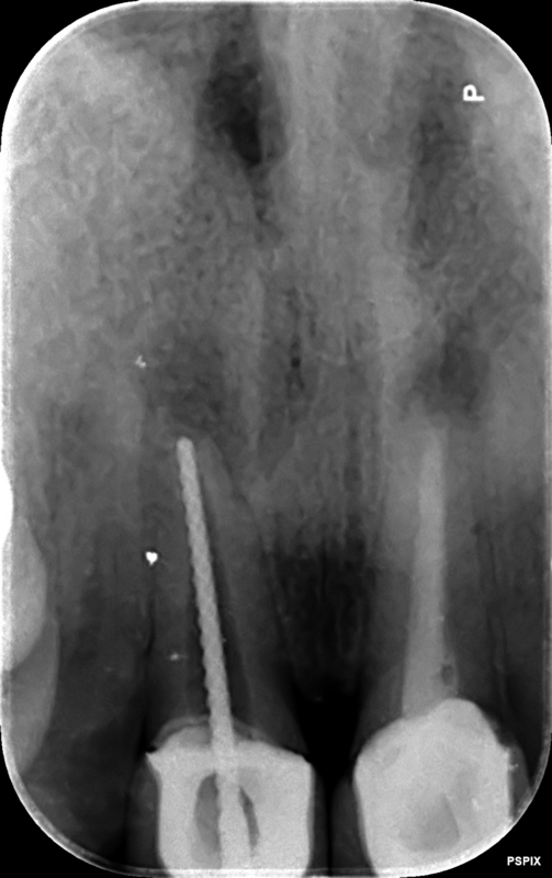 Case 19 - Endodontics - Graystone Referral Centre | Referrals in ...